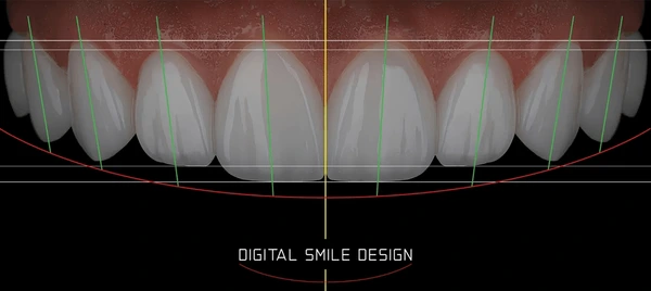 Smile Design – Seferihisar Dentist