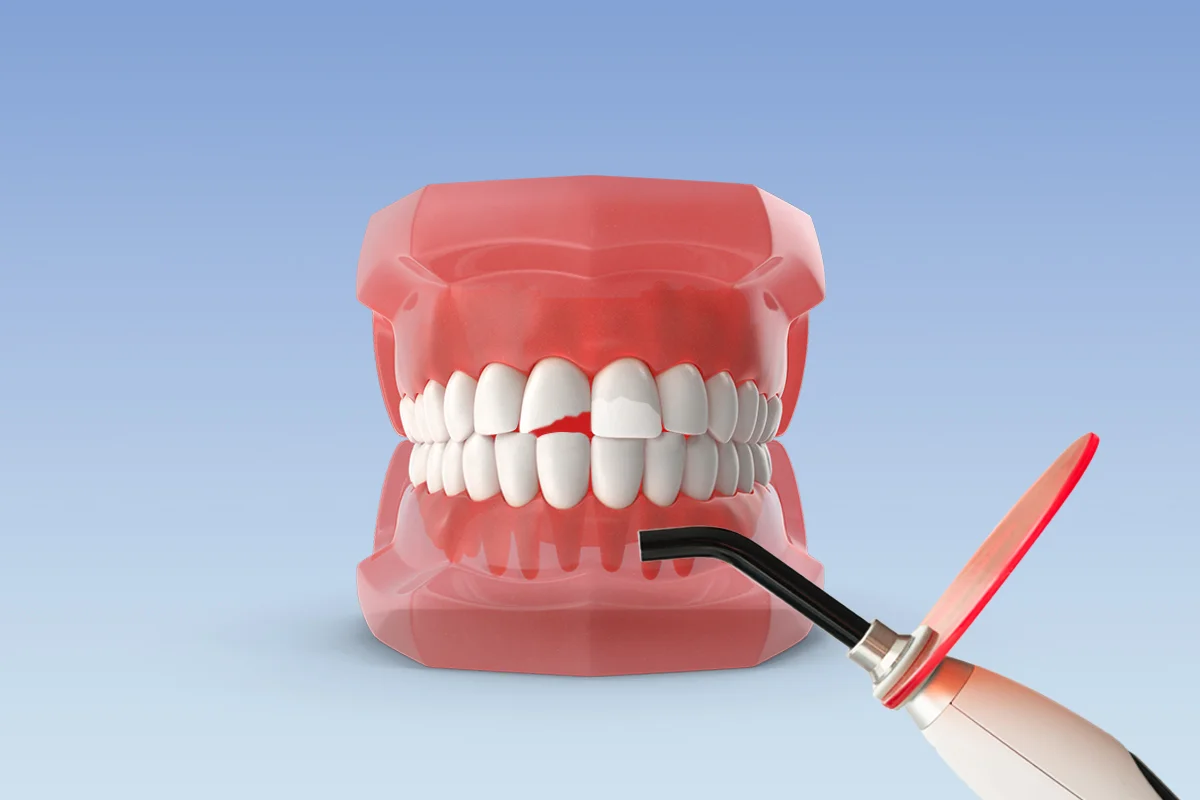 Composite Bonding – Seferihisar Dentist